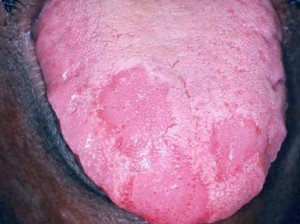 👉 Glossitis - Symptoms, Causes, Treatment, Pictures (December 2021)