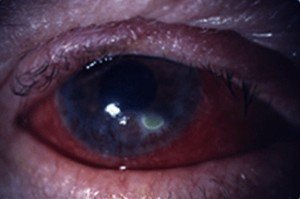 👉 Corneal Ulcer - Pictures, Symptoms, Causes, Treatment (November 2021)
