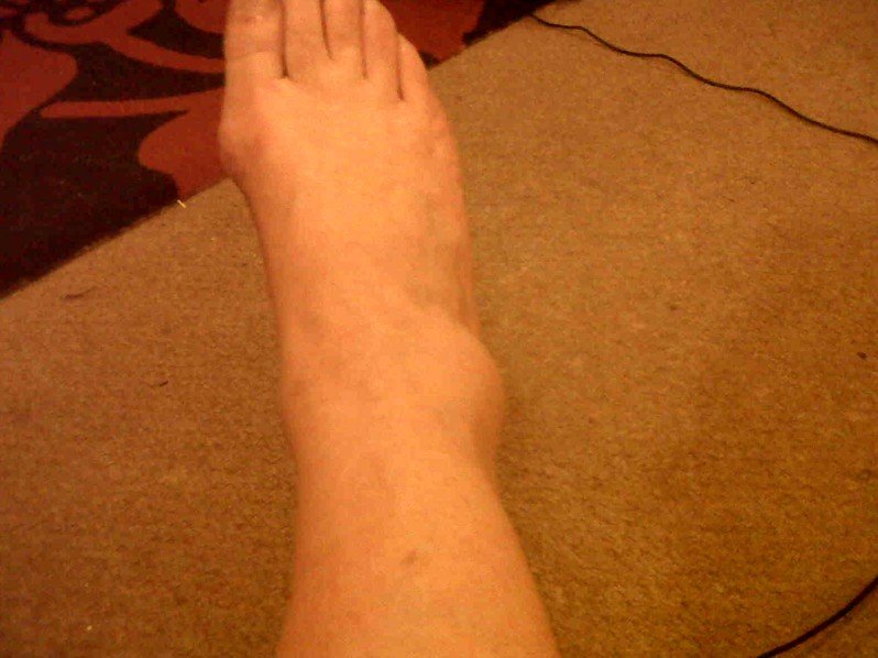 Broken Ankle Symptoms Recovery Time Pictures Surgery Treatment Broken Ankle Symptoms Recovery Time Pictures Surgery Treatment