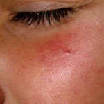 👉 Spider Angioma - Symptoms, Causes, Pictures, Treatment (November 2021)