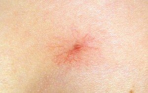 👉 Spider Angioma - Symptoms, Causes, Pictures, Treatment (November 2021)