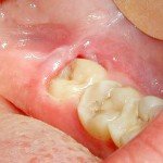 👉 Pericoronitis - Pictures, Treatment, Symptoms, Causes (February 2022)