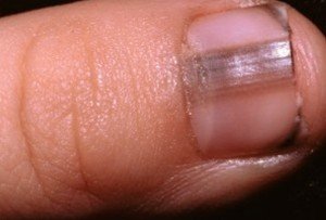 👉 Subungual Melanoma - Pictures, Treatment, Symptoms, Causes (December ...
