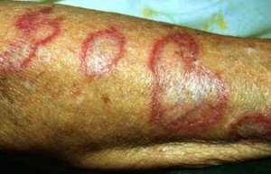 👉 Discoid Lupus - Pictures, Symptoms, Treatment, Causes (December 2021)