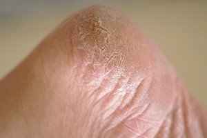 👉 Foot Fungus - Pictures, Types, Causes, Symptoms, Treatment (January 2022)