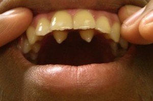 👉 Hyperdontia - Pictures, Causes, Treatment (February 2022)