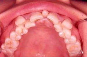 👉 Hyperdontia - Pictures, Causes, Treatment (February 2022)