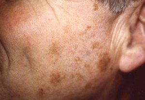 👉 Liver Spots - Pictures (Face, Skin, Hands), Causes, Treatment ...