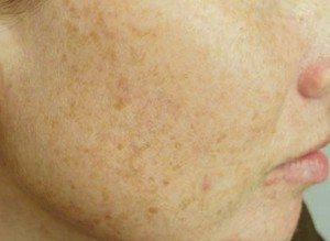 👉 Liver Spots - Pictures (Face, Skin, Hands), Causes, Treatment ...