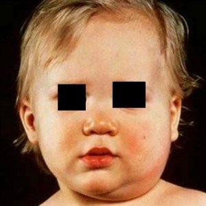 👉 Parotid Gland Swelling - Symptoms, Pictures, Causes, Treatment ...
