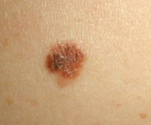 👉 Melanocytic Nevus - Pictures, Symptoms, Diagnosis, Treatment ...