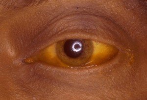 👉 Yellowing of the Eyes - Causes, Treatment, Pictures (February 2022)