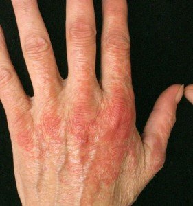 👉 Photodermatitis - Pictures, Treatment, Symptoms and Causes (November ...