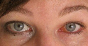Swollen Eyeball - Pictures, Causes, Diagnosis, Treatment