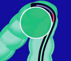 👉 Splenic Flexure Syndrome - Location, Symptoms, Diet, Treatment ...