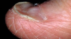 👉 Koilonychia Definition - Causes, Pictures (photos), Treatment ...