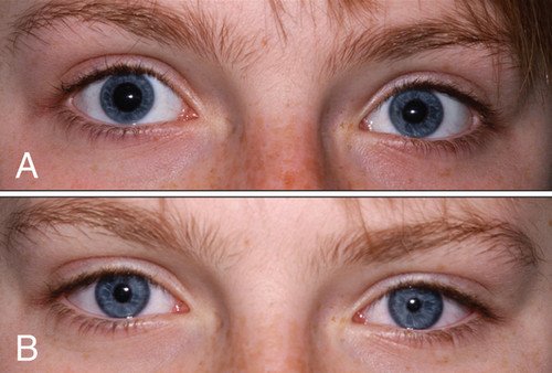 What Does Pinpoint Pupils Mean And Causes drugs February 2022 What Does Pinpoint Pupils Mean And Causes drugs February 2022