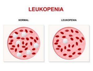 👉 What is Leukopenia - Definition (ICD 10), Causes, Symptoms, Treatment ...