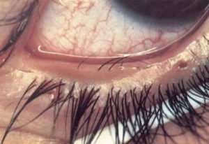 👉 Ingrown Eyelash - Removal (Surgery) (January 2022)