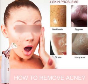 👉 Microdermabrasion at Home (November 2021)