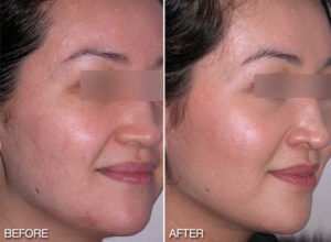 👉 Microdermabrasion at Home (November 2021)